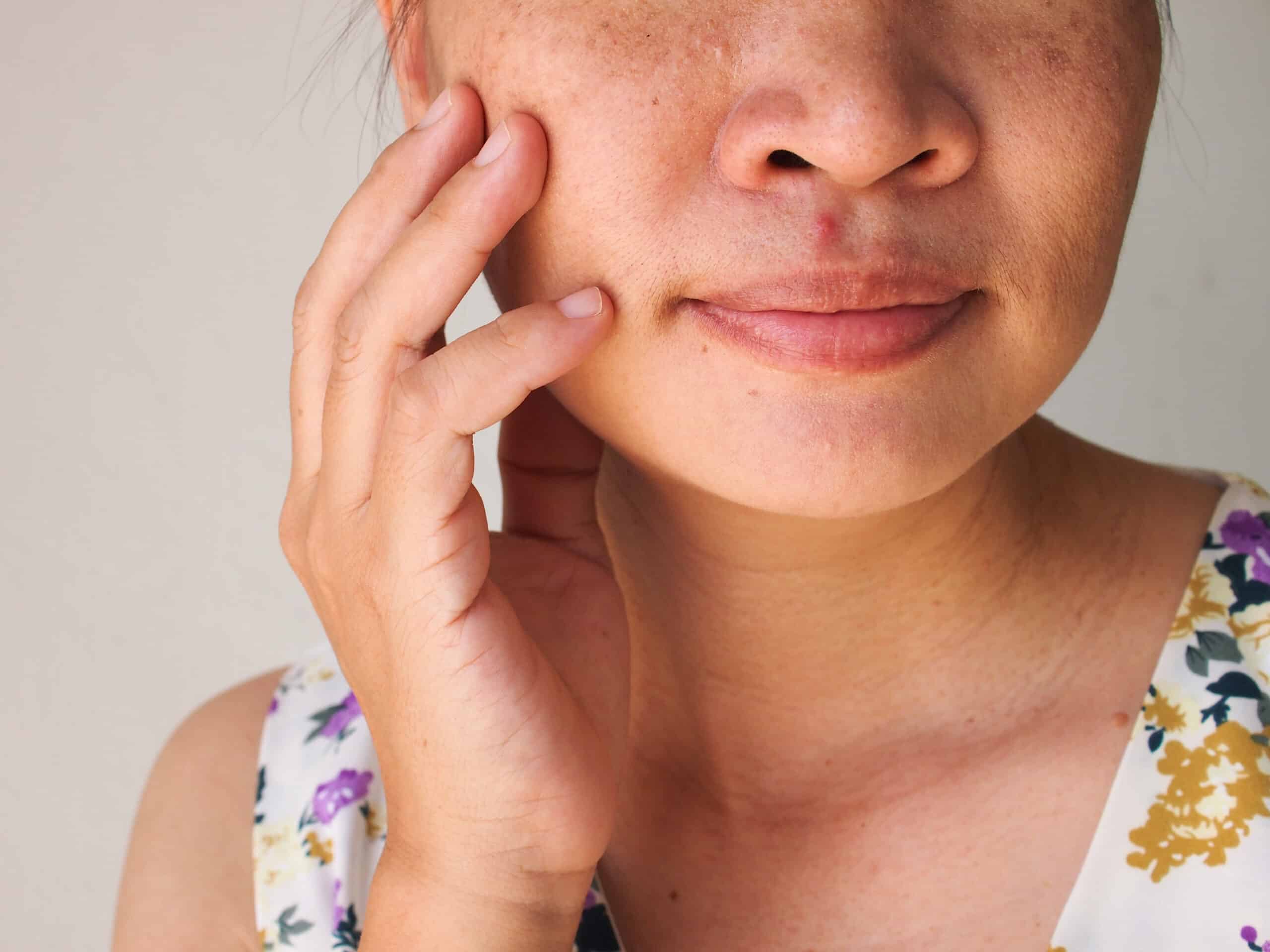 Sun Damaged Skin Treatment | San Francisco, CA