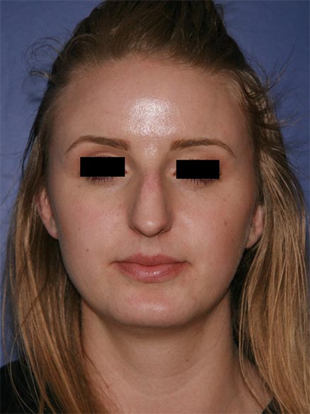 Rhinoplasty Before and After Photos San Francisco #4733