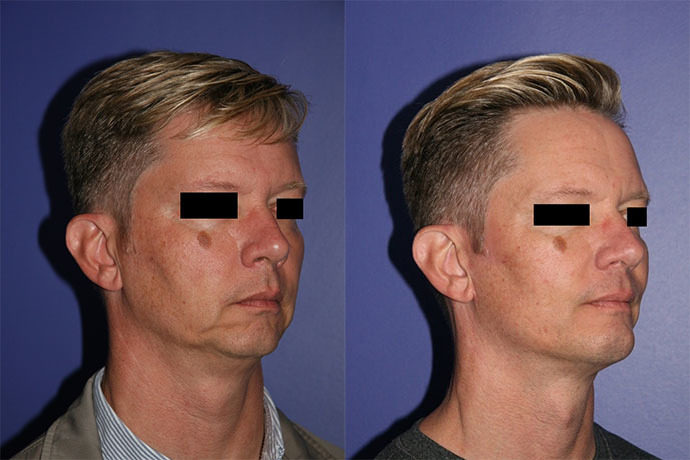 Facelift Before and After Photos San Francisco #11142018
